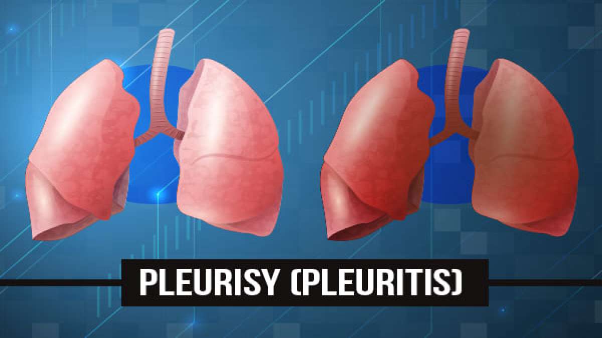 Pleurisy (Inflammation Of The Lung Lining): Symptoms, Causes ...
