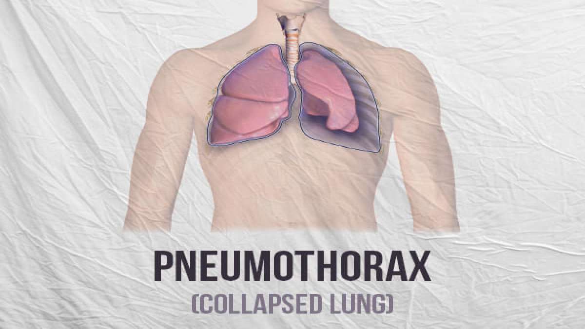 Pneumothorax (Collapsed Lung): Types, Causes, Symptoms, Risk Factors ...