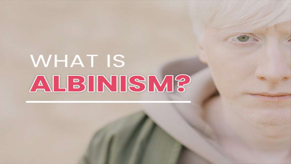 International Albinism Awareness Day 2021: What Is Albinism? Causes ...