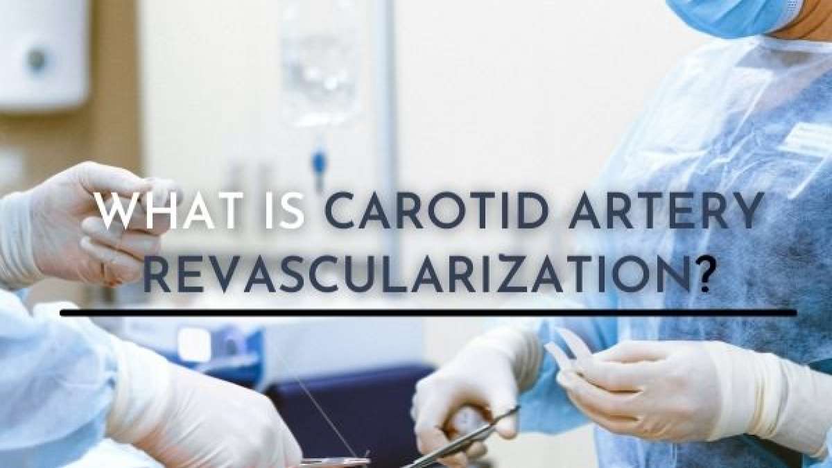 What Is Carotid Artery Revascularization: Everything You Need To Know ...