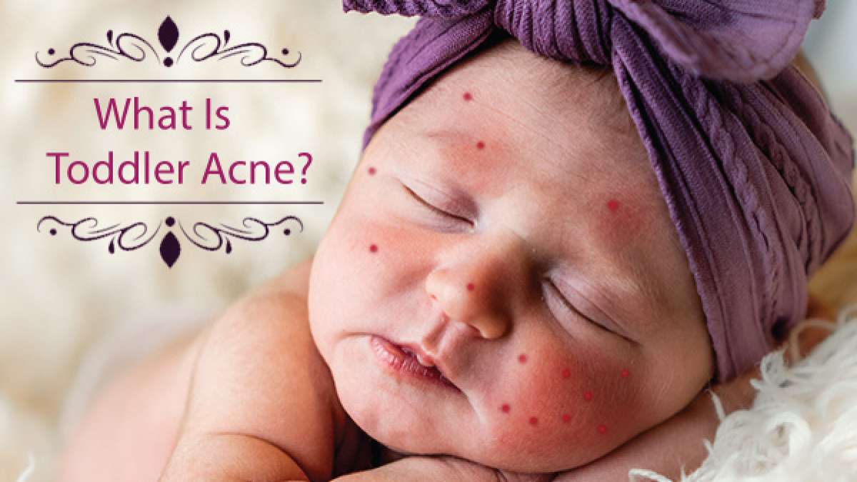 What Is Toddler Acne? Causes, Symptoms, Complications, Diagnosis And ...