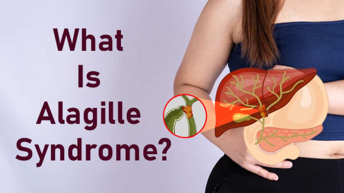 What Is Alagille Syndrome? Causes, Symptoms, Diagnosis And Treatment ...