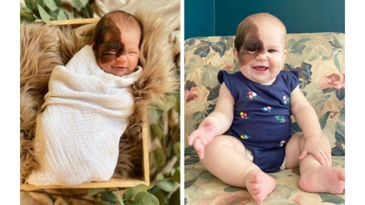 Mom Celebrates Unique Beauty Of Her Daughter Born With A Rare Birthmark ...