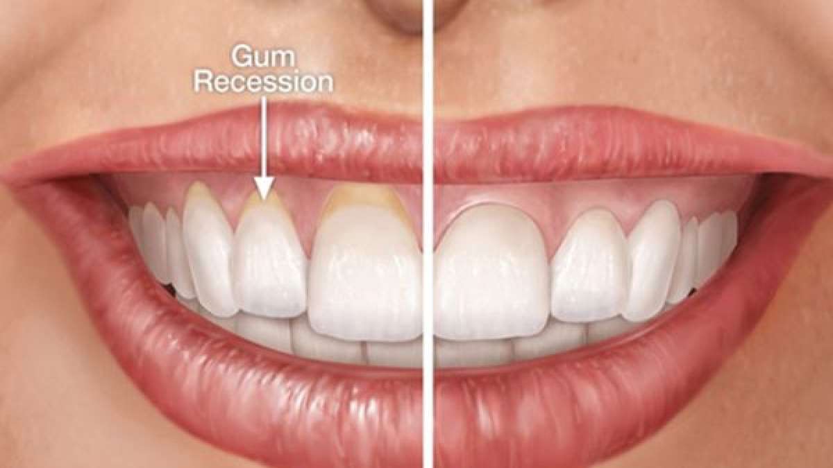 Receded Gums: Causes, Symptoms, Diagnosis And Treatment - Boldsky.com