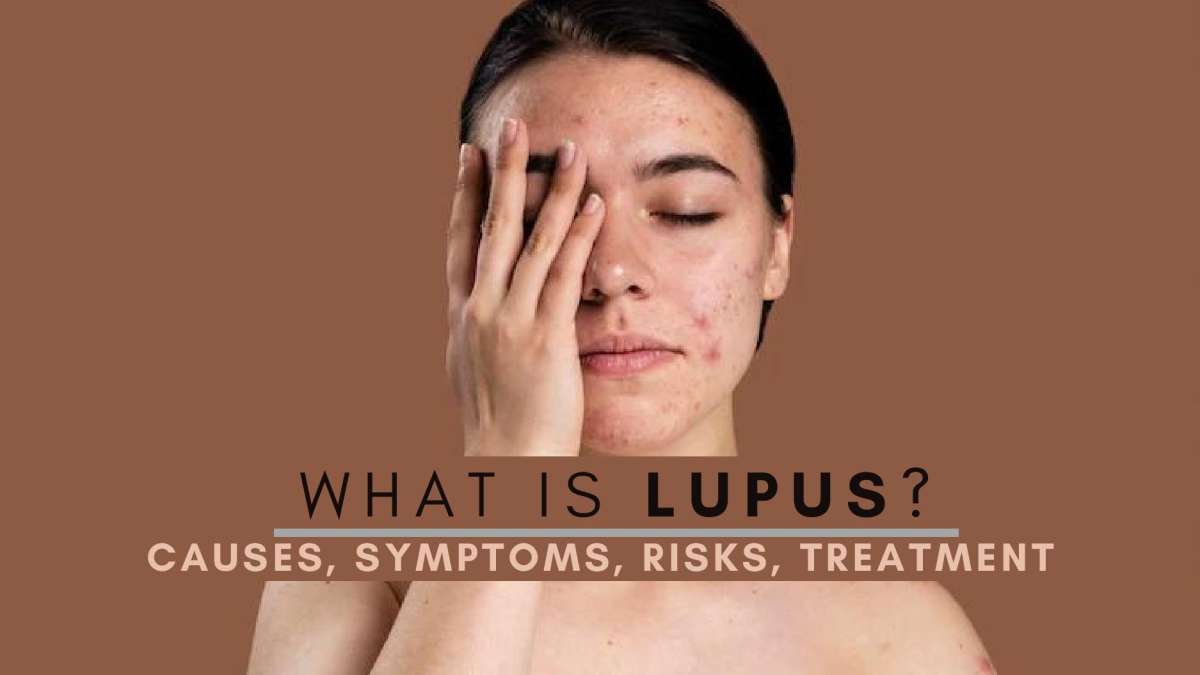 Lupus: What Causes This Autoimmune Condition? Types, Symptoms ...