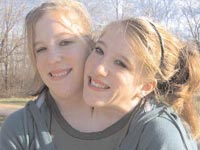 British Dicephalus twins Live To Teens - Boldsky.com