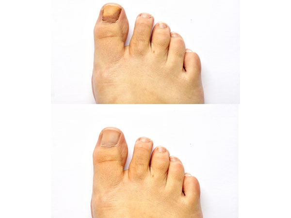 5 Signs Of Diseases Revealed By Feet - Boldsky.com