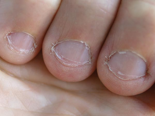 Nasty Facts About Nail Biting - Boldsky.com