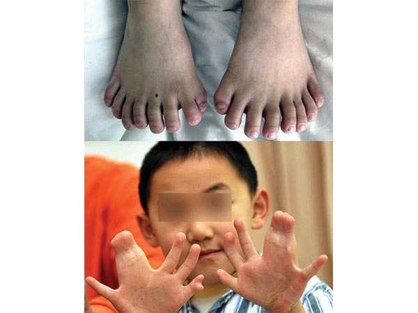 Strange Extra Body Parts That Were Found In Humans - Boldsky.com