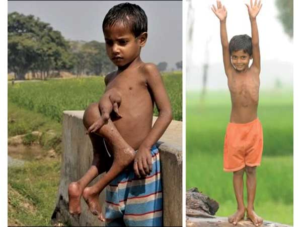 Strange Extra Body Parts That Were Found In Humans - Boldsky.com