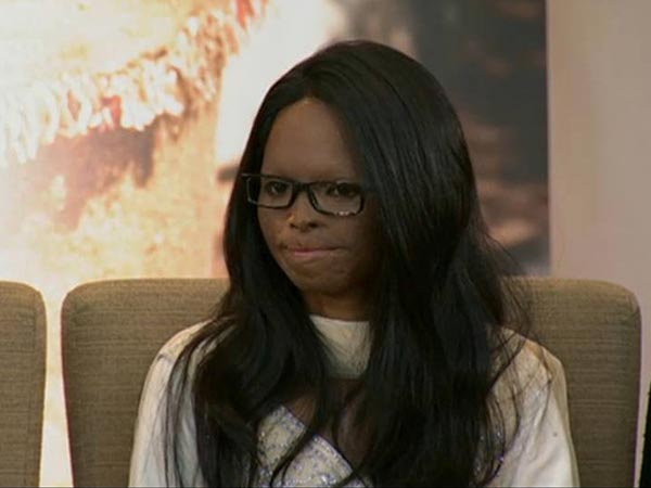 5 Acid Attack Victims Who Are Amazing - Boldsky.com