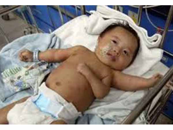 Unbelievable Genetic Accidents That Will Shock You - Boldsky.com