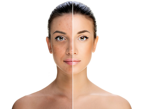 10 Best Home Remedies To Treat Skin Discolouration - Boldsky.com