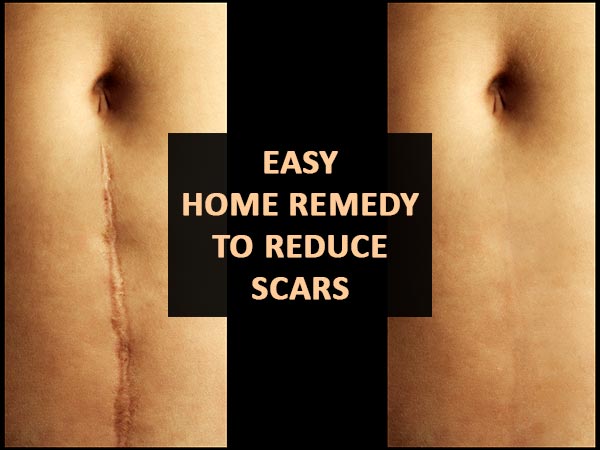Try This Powerful Home Remedy To Reduce Injury Scars! - Boldsky.com