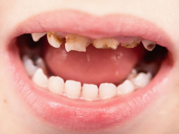 Shocking Diseases Of The Mouth - Boldsky.com