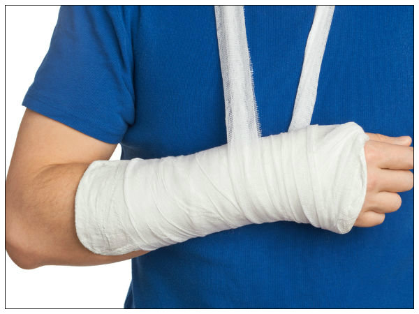 How To Heal Broken Bones Faster - Boldsky.com