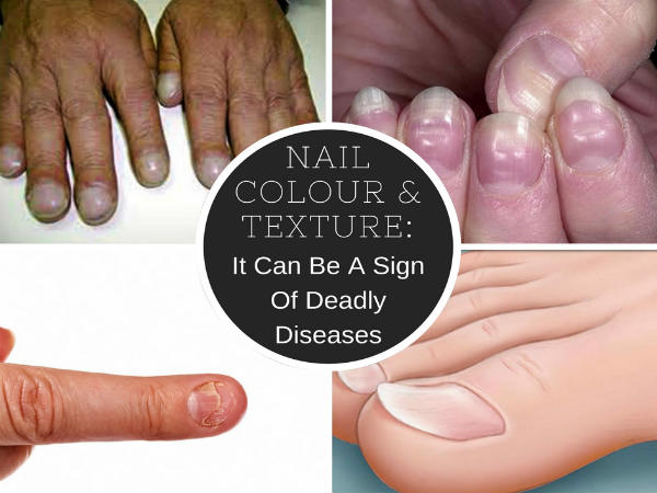 Nail Colour & Texture: It Can Be A Sign Of These Deadly Diseases ...