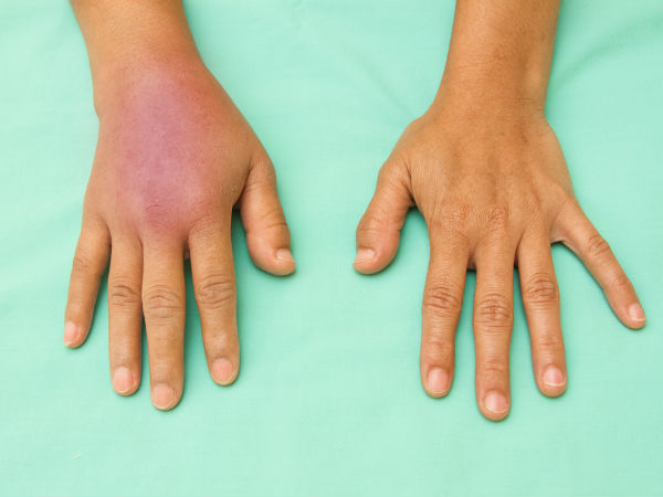 Tips To Get Rid Of Swelling - Boldsky.com