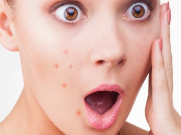 Ever Wondered How To Make A Zit Disappear In One Day? Here’s How ...