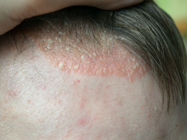 Causes And Signs Of Scalp Inflammation - Boldsky.com