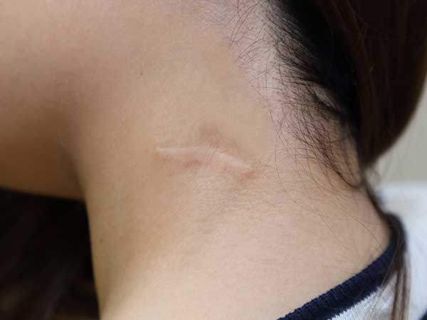 Easy Steps To Hide A Scar With Makeup - Boldsky.com