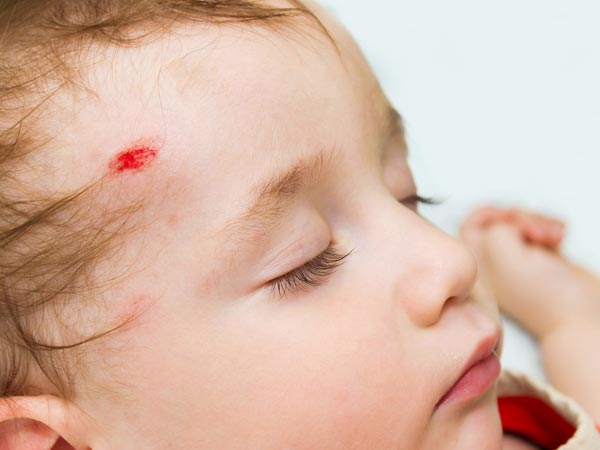 Signs Of Concussions In Kids - Boldsky.com