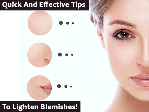 Quick & Effective Tips To Lighten Blemishes! - Boldsky.com