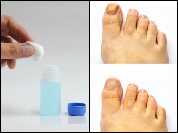 Surprising Health Benefits Of Rubbing Alcohol You Didn't Know - Boldsky.com