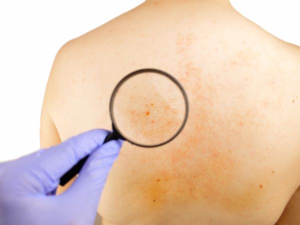 Why Are There White Patches On Your Body & How To Fix Them? - Boldsky.com