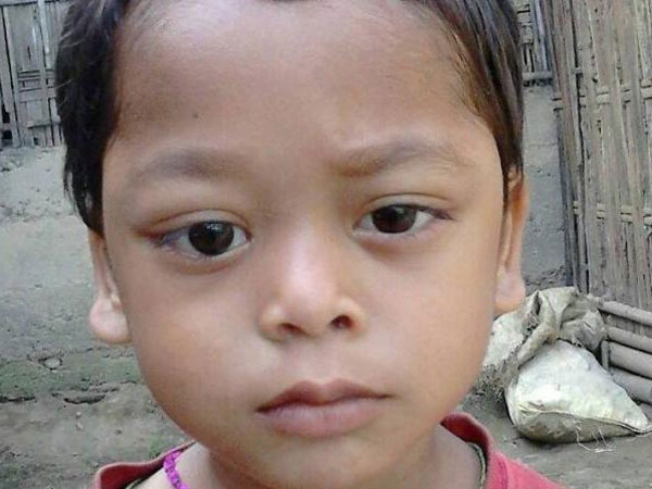 This Kid Had A Rare Disease Of Bleeding Eyes - Boldsky.com