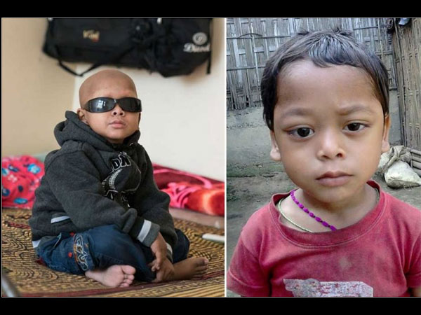 This Kid Had A Rare Disease Of Bleeding Eyes - Boldsky.com