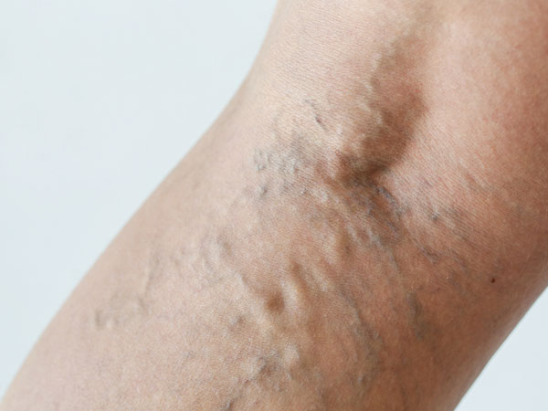 Top Warning Signs Of Poor Blood Circulation - Boldsky.com