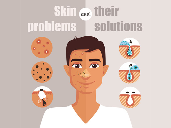 Quick Home Remedies To Treat Under-The-Skin Pimples - Boldsky.com