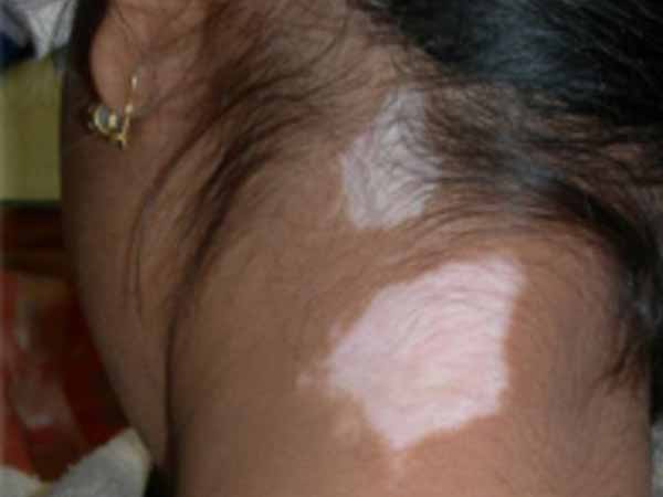 What Do Your Skin Patches Mean? - Boldsky.com