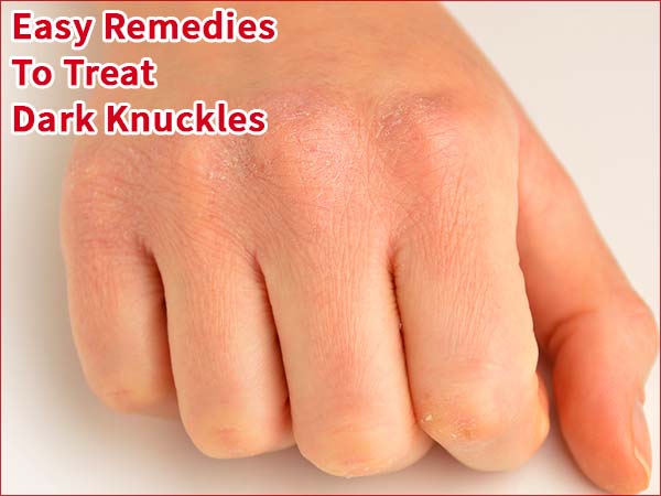 ­Easy Home Remedies To Treat Dark Knuckles - Boldsky.com