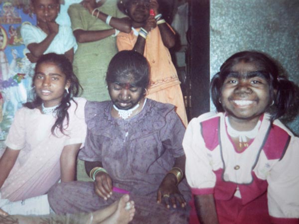 Her Son Inherited The 'Werewolf Baby' Gene - Boldsky.com