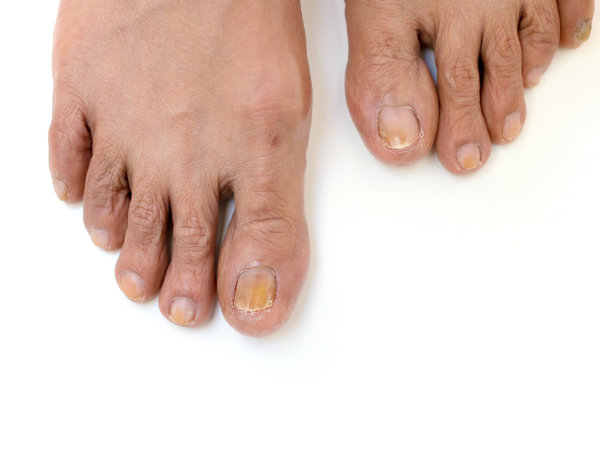 6 Dangerous Reasons Why Your Toe Nails Are Getting Darker! - Boldsky.com