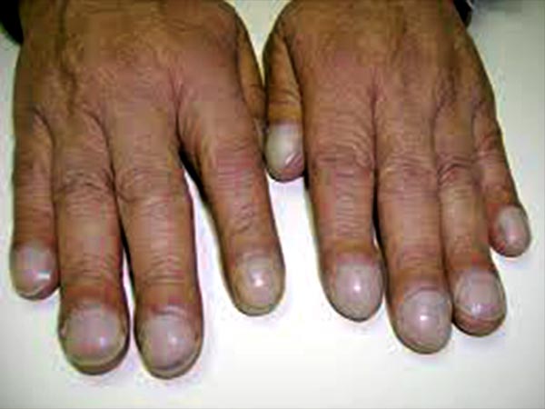 20 Cancer Symptoms That Women Are Likely To Ignore - Boldsky.com