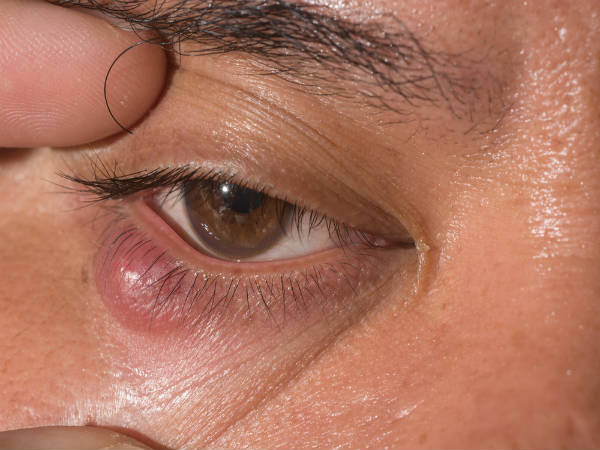 What Are The Most Common Causes Of A Swollen Eye Lid