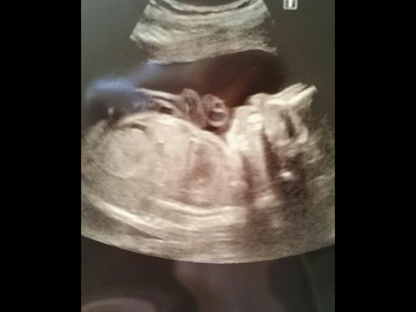 Britain's First Pregnant Man Gives Birth To A Baby Girl - Boldsky.com