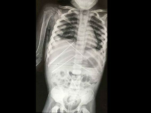 Needles Were Found Inside A Girl’s Body After Horrific 'Black Magic ...