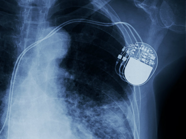 60 Year Old Gets The Smallest Pacemaker Implant - Boldsky.com