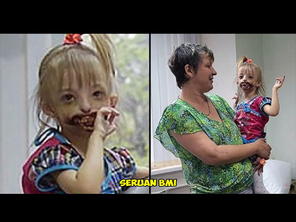 Child Who Has No Lips And Chin! - Boldsky.com