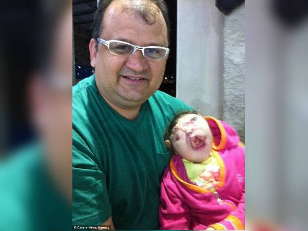 She Did Not Have A Face When She Was Born, Yet She Survived - Boldsky.com