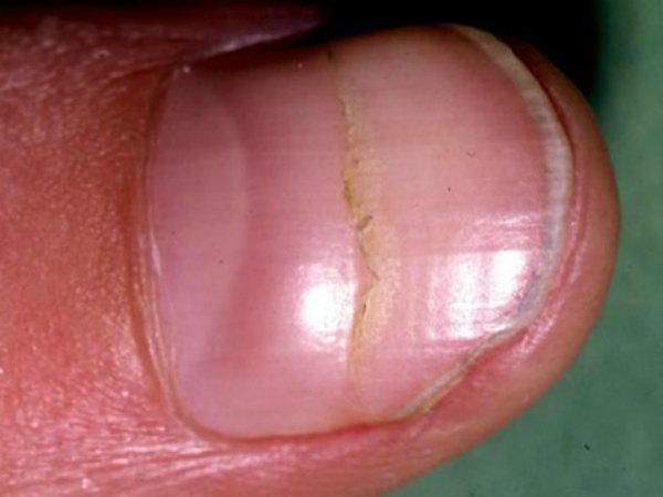 What Do Your Nails Say About Your Health? Come Find Out. - Boldsky.com