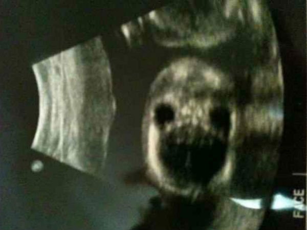 Scary Ultrasound Scans That Can Give You Goosebumps - Boldsky.com