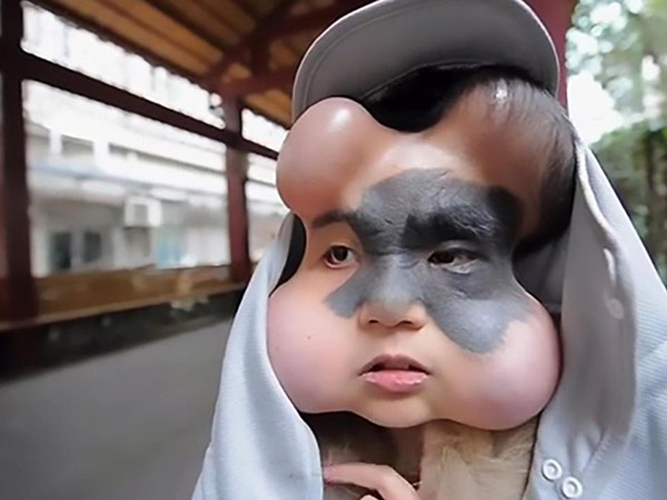 Weird Case Of A Woman Who Has Balloons Inserted In Her Face - Boldsky.com