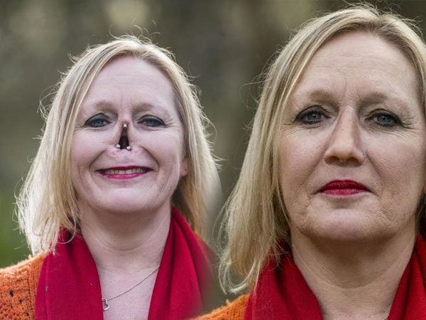 Real-Life Story: She Explains Her Life Of Having A Prosthetic Nose ...