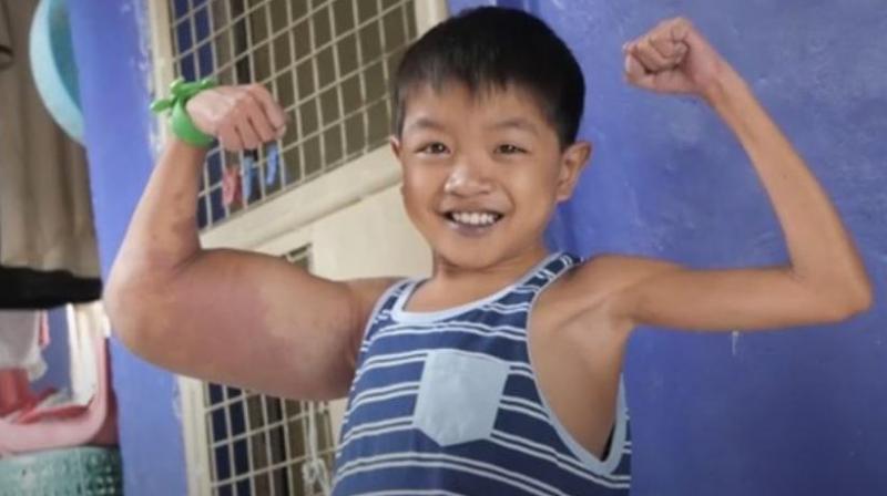 People Call Him ‘Popeye’ After Mystery Condition Gives Him Huge Biceps ...