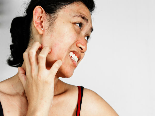 Basic Tips To Treat Skin Inflammations - Boldsky.com